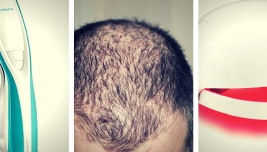 The 3 BEST Laser Caps (Hair Growth Helmets): 2018 Reviews & Comparison